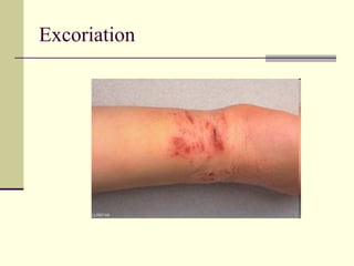 Excoriation Histology
