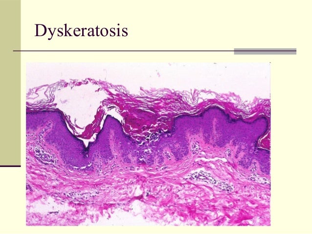 Excoriation Histology