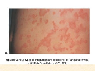 Skin Pathology (Disease of the Integumentary System) | PPT