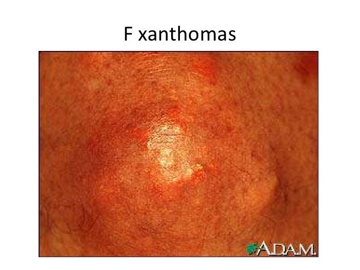 Xanthomas Causes And Treatment Options Skin Site