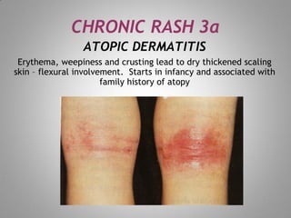 skin rash for dermatology field in medical field | PPT