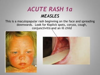skin rash for dermatology field in medical field | PDF