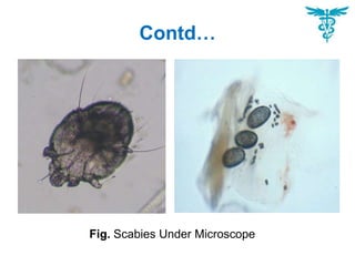 Skin Scraping For Scabies