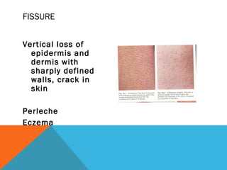 basics lesions of skin - Dr. Gurjot Marwah | PPT