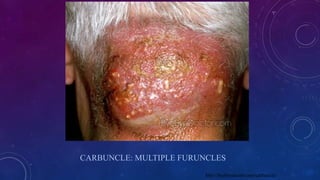 Skin, soft tissue, and hand infection | PPT