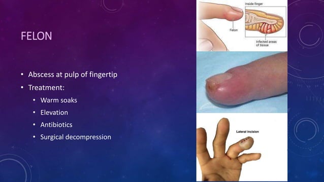 Skin, soft tissue, and hand infection | PPT