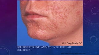 Skin, soft tissue, and hand infection | PPTX