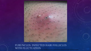 Skin, soft tissue, and hand infection | PPT