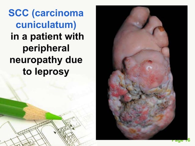 Squamous Cell Carcinoma (SCC) | PPT | Cancer | Diseases and Conditions