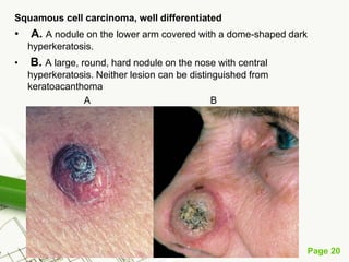Squamous Cell Carcinoma (SCC) | PPT
