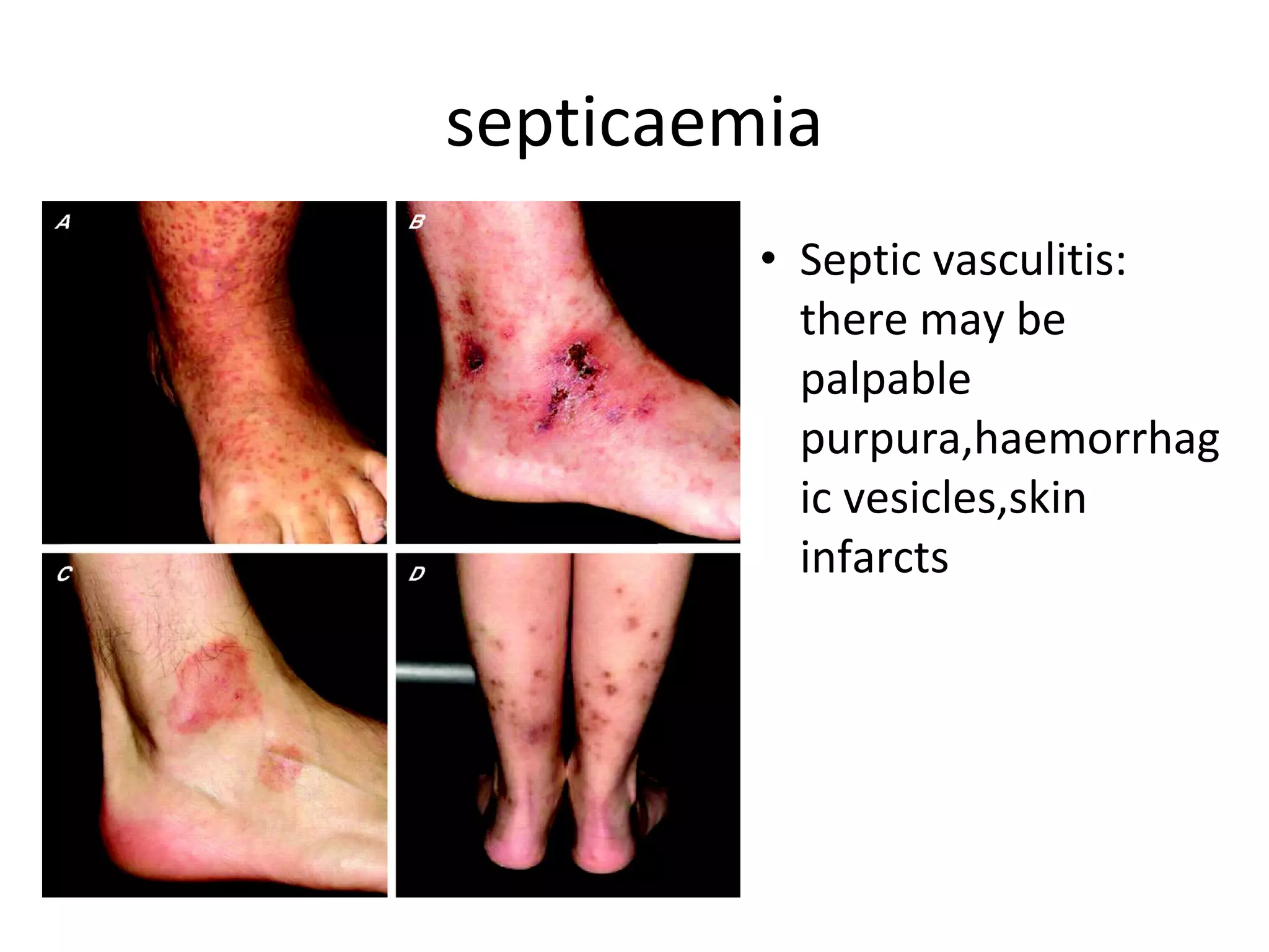 Skin systemic infections final | PDF