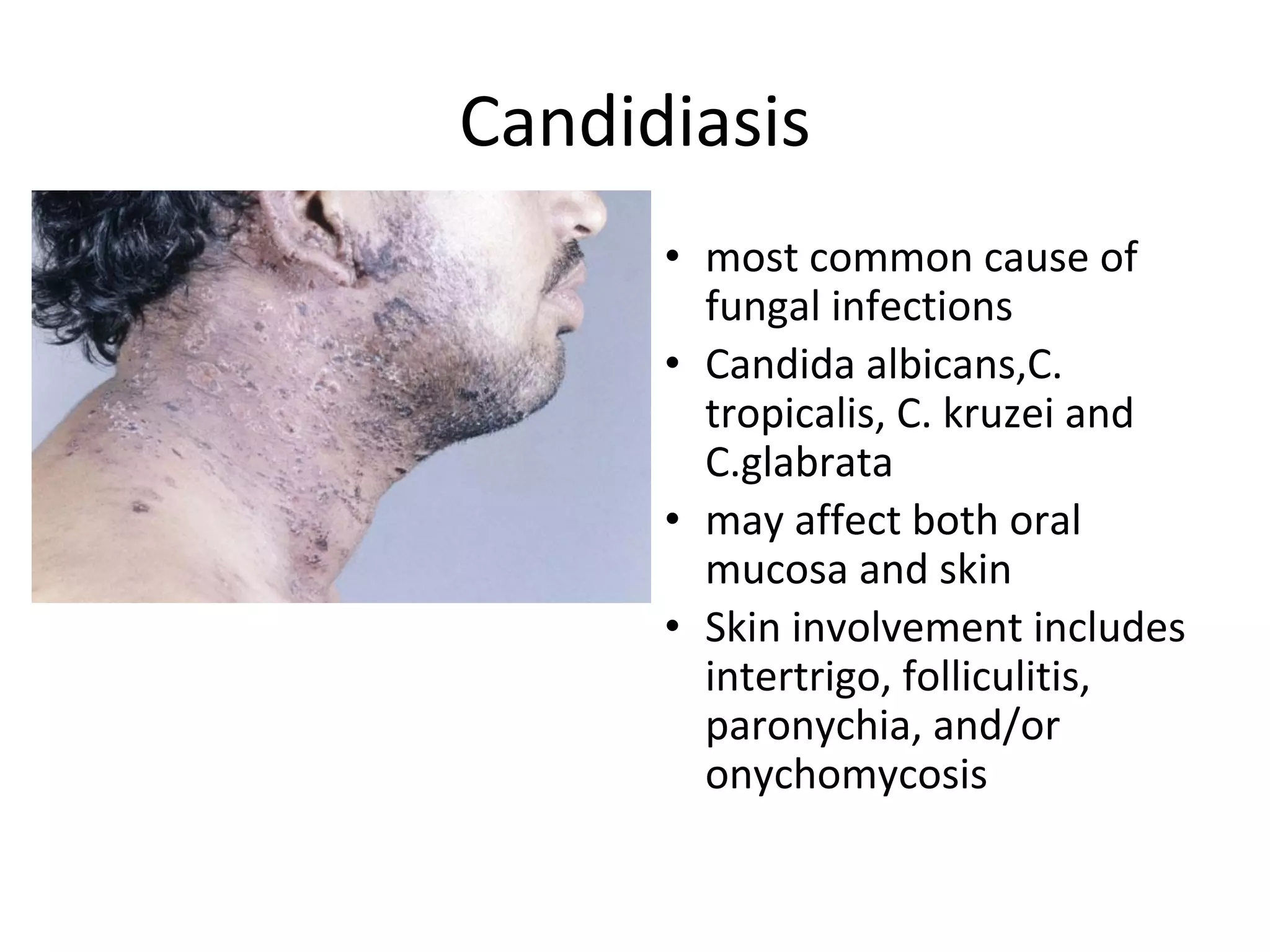 Skin systemic infections final | PPT