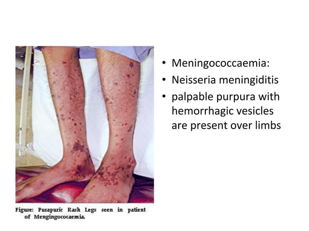 Skin systemic infections final | PPT