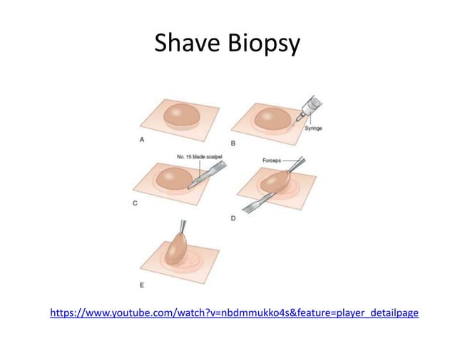 Skin Tag Removal and Skin Biopsies.pptx