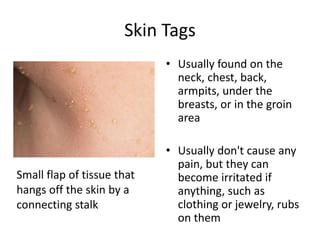 Skin Tag Removal and Skin Biopsies.pptx