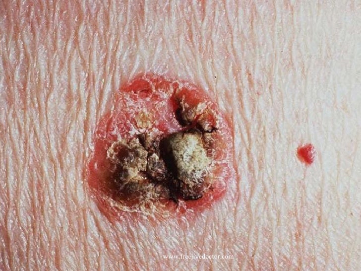 Skin tumors