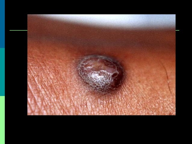 Benign and Malignant Skin Leisions | PPT