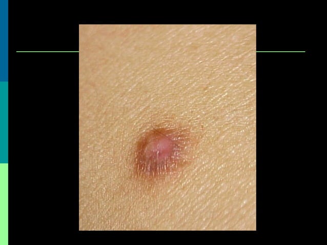 Benign and Malignant Skin Leisions | PPT