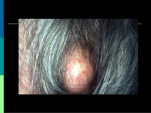 Benign and Malignant Skin Leisions