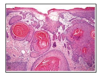 Pathology of skin tumors in detail 12.pptx