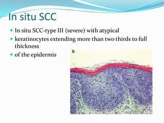 Skin tumours pathology | PPTX