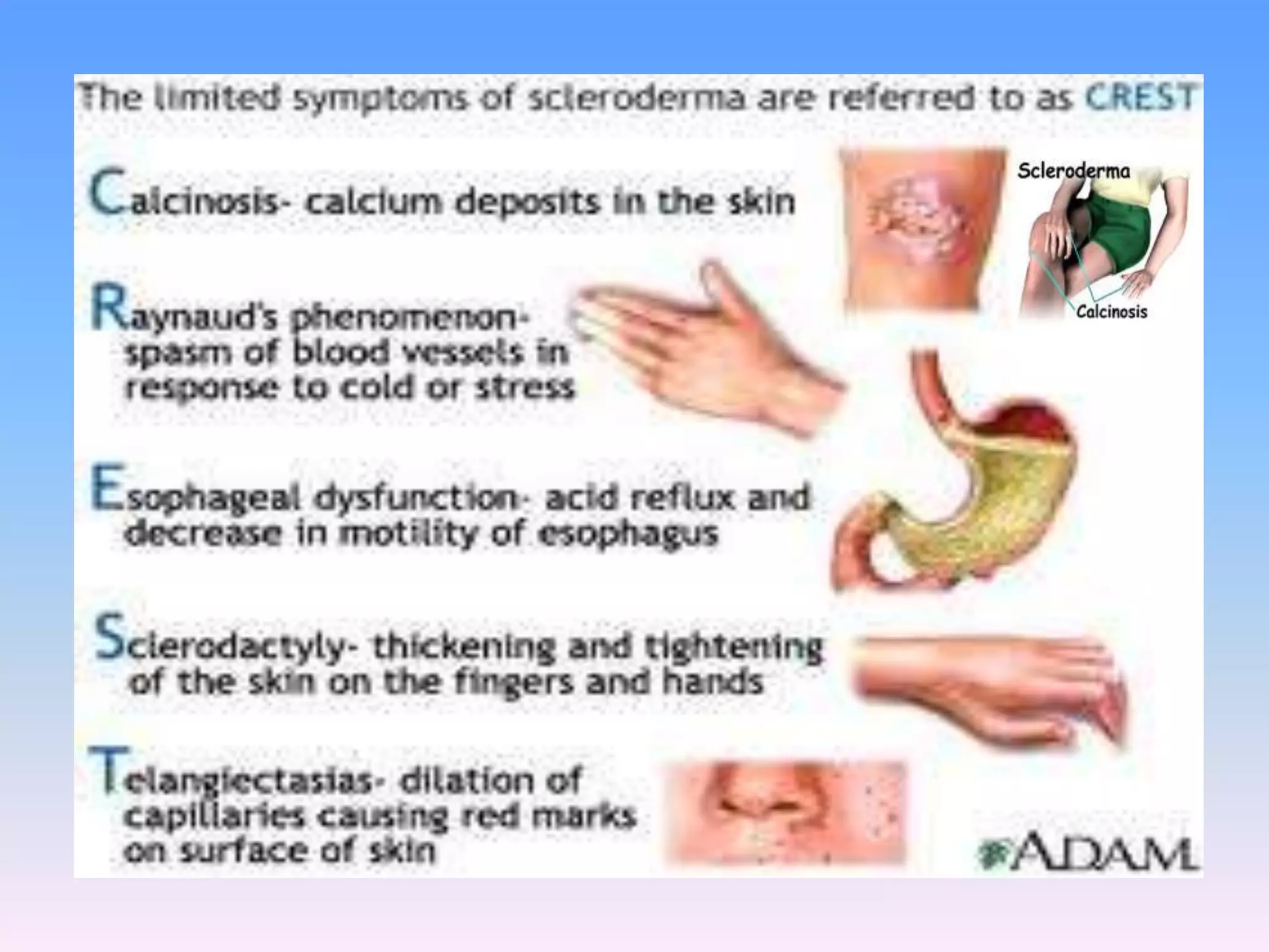 Skleroderma ppt | PPTX