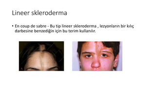 Skleroderma | PPTX
