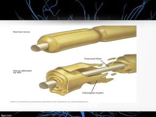 Skleroza_Multiple (1).pptx