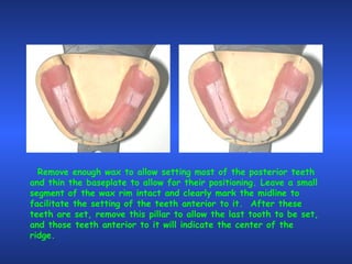 tooth arrangement for preclinical prosthodontics | PPT