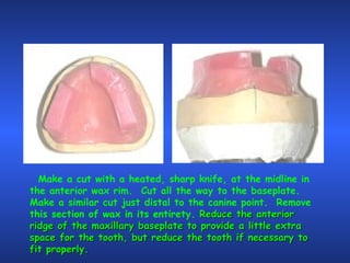 tooth arrangement for preclinical prosthodontics | PPT