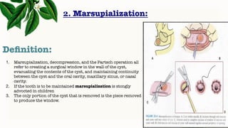 management of dentigerous cyst | PDF
