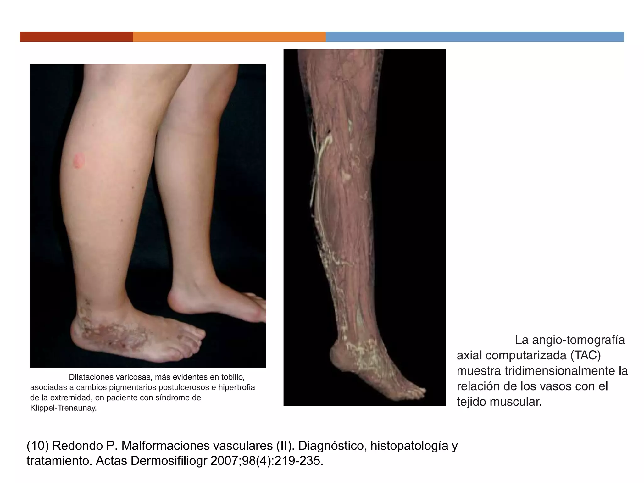 Klippel Trenaunay Syndrome Ppt