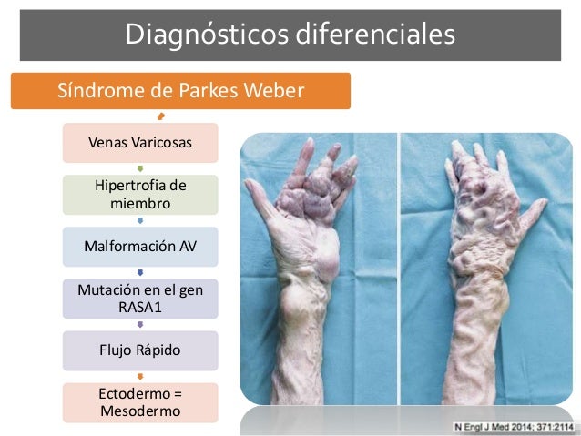 Klippel Trenaunay Syndrome