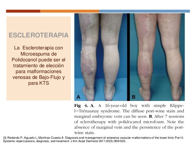 Klippel Trenaunay Syndrome