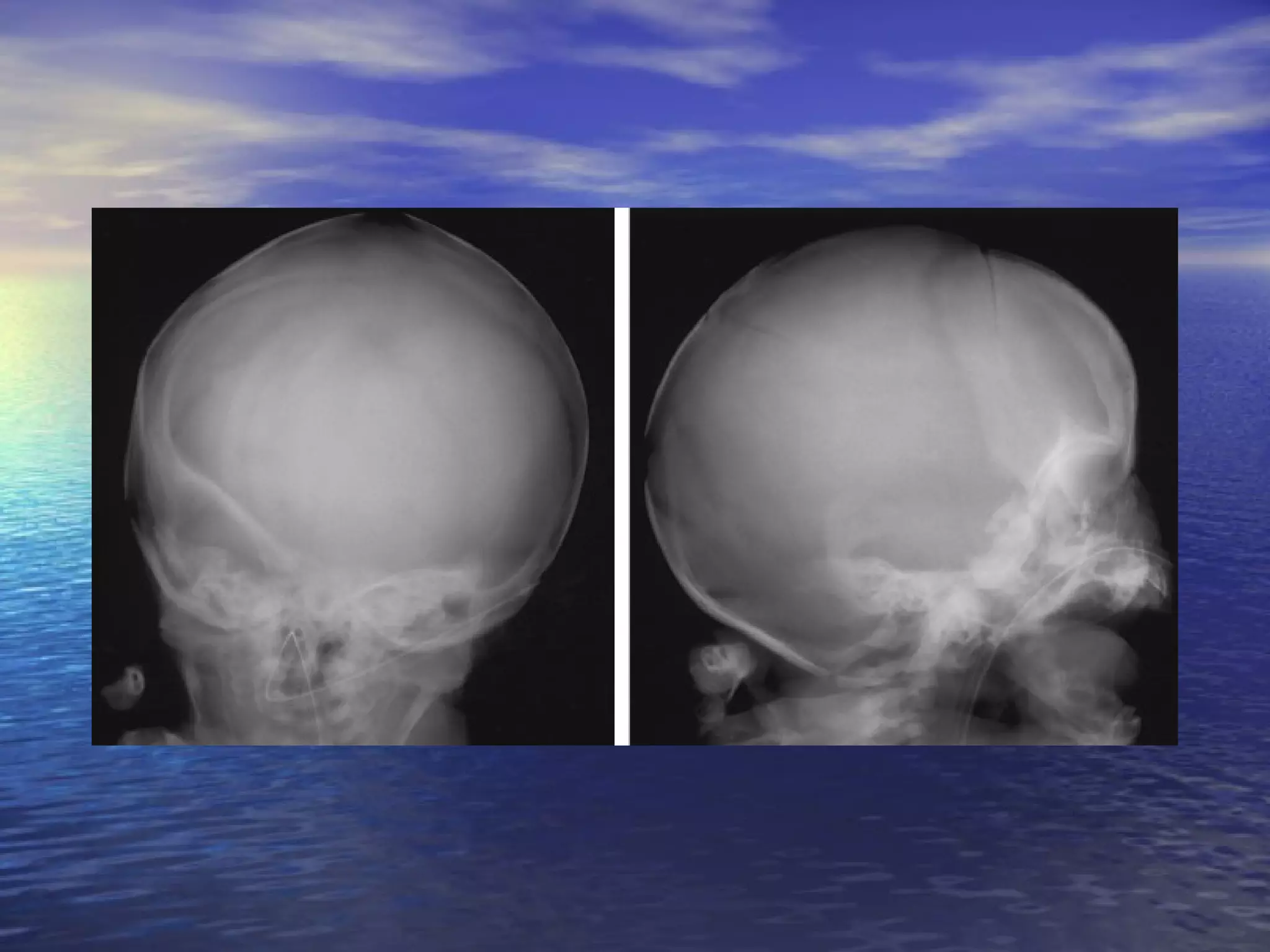Infant Skull Radiographs | PPT