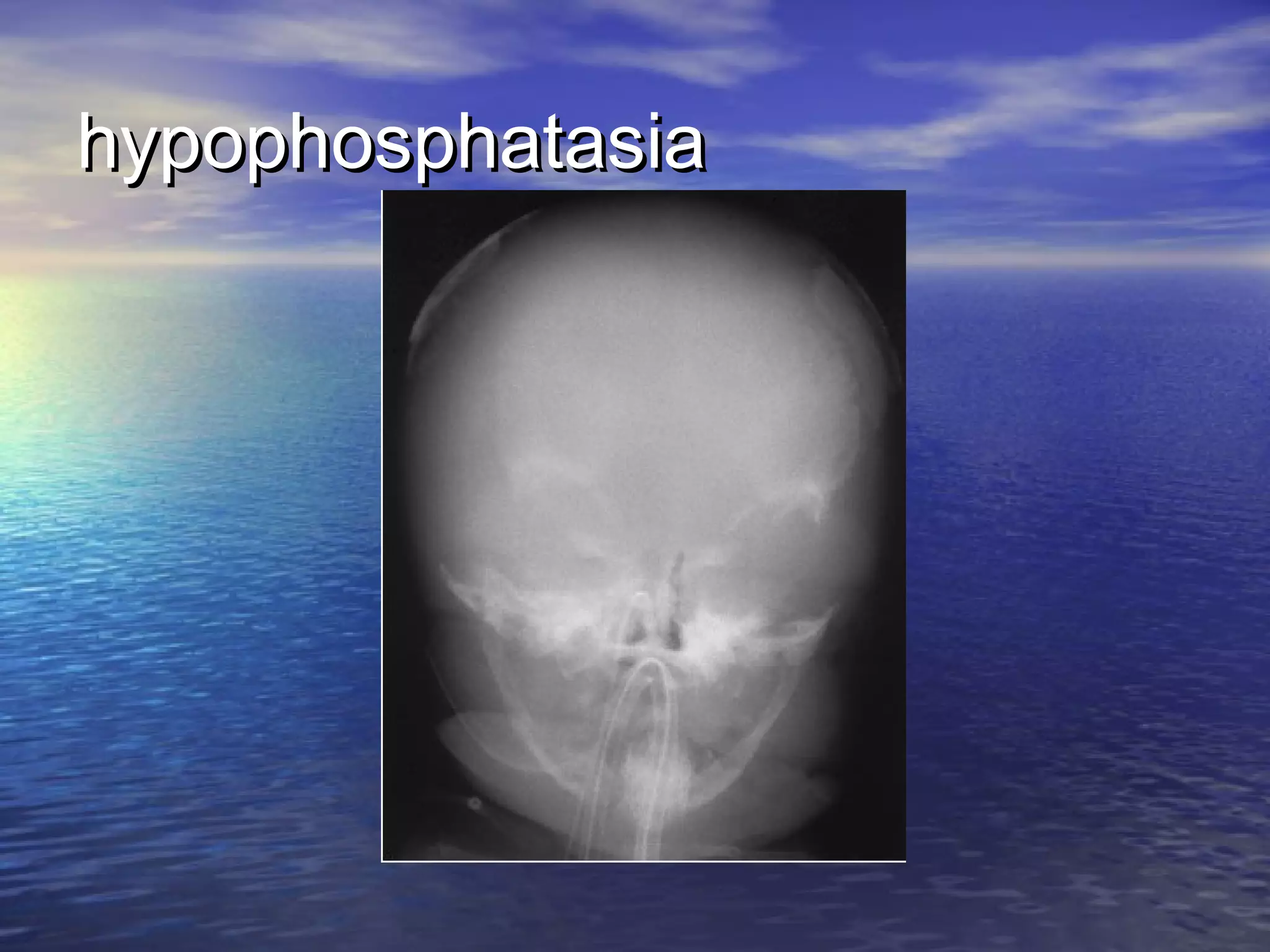 Infant Skull Radiographs | PPT