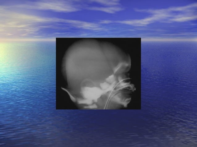 Infant Skull Radiographs | PPT | Bone and Joint Conditions | Diseases ...