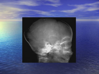 Infant Skull Radiographs | PPT