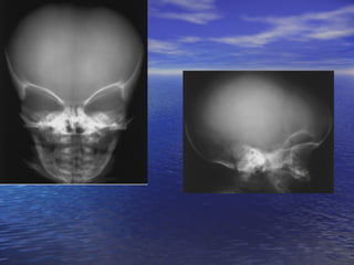 Infant Skull Radiographs | PPT