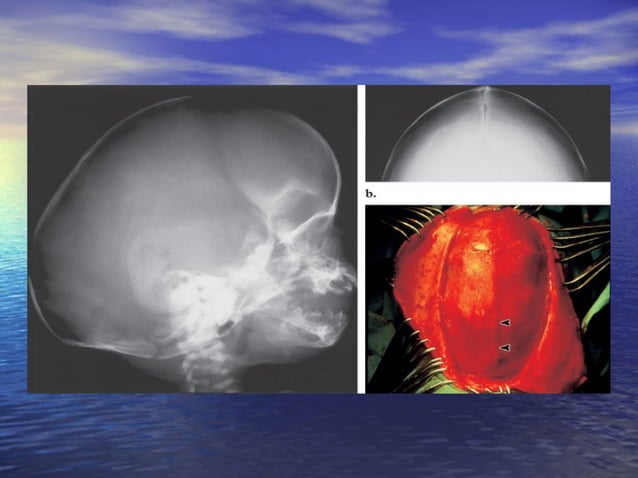 Infant Skull Radiographs | PPT | Bone and Joint Conditions | Diseases ...