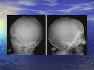 Infant Skull Radiographs | PPT
