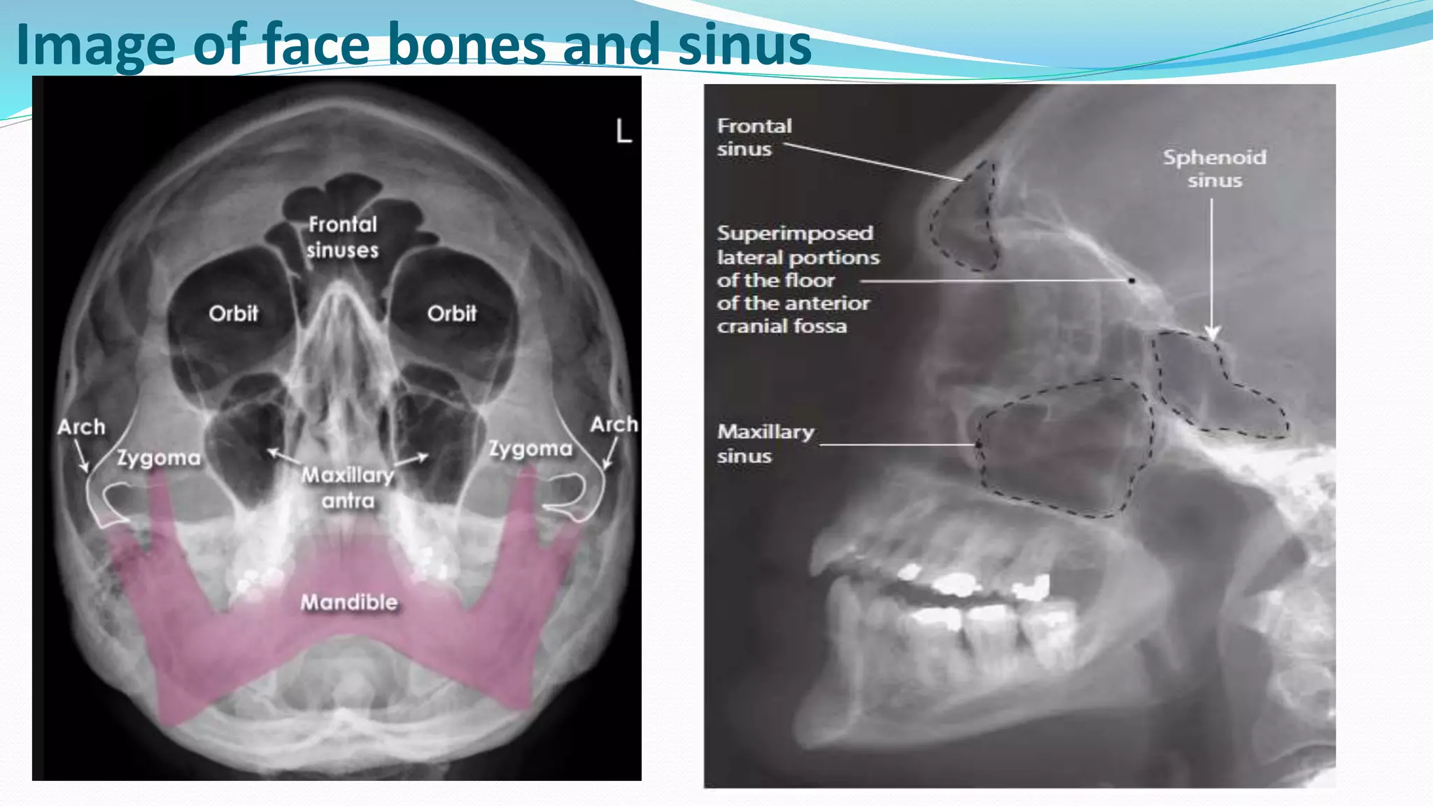 Radiography Anatomy of Skull | PPTX