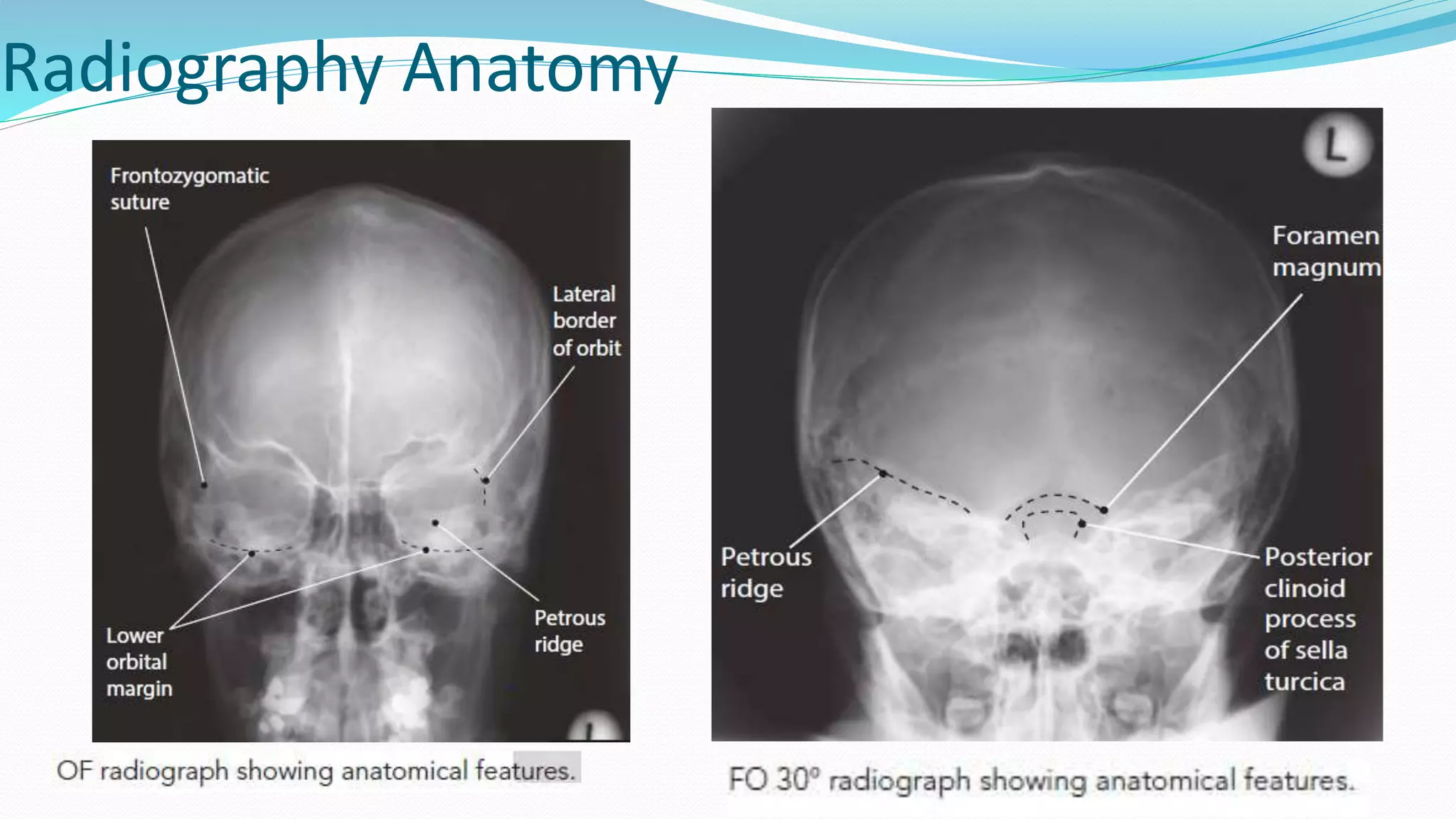 Radiography Anatomy of Skull | PPTX