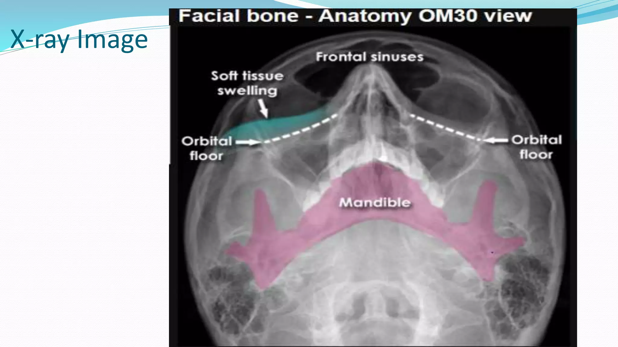 Radiography Anatomy of Skull | PPTX