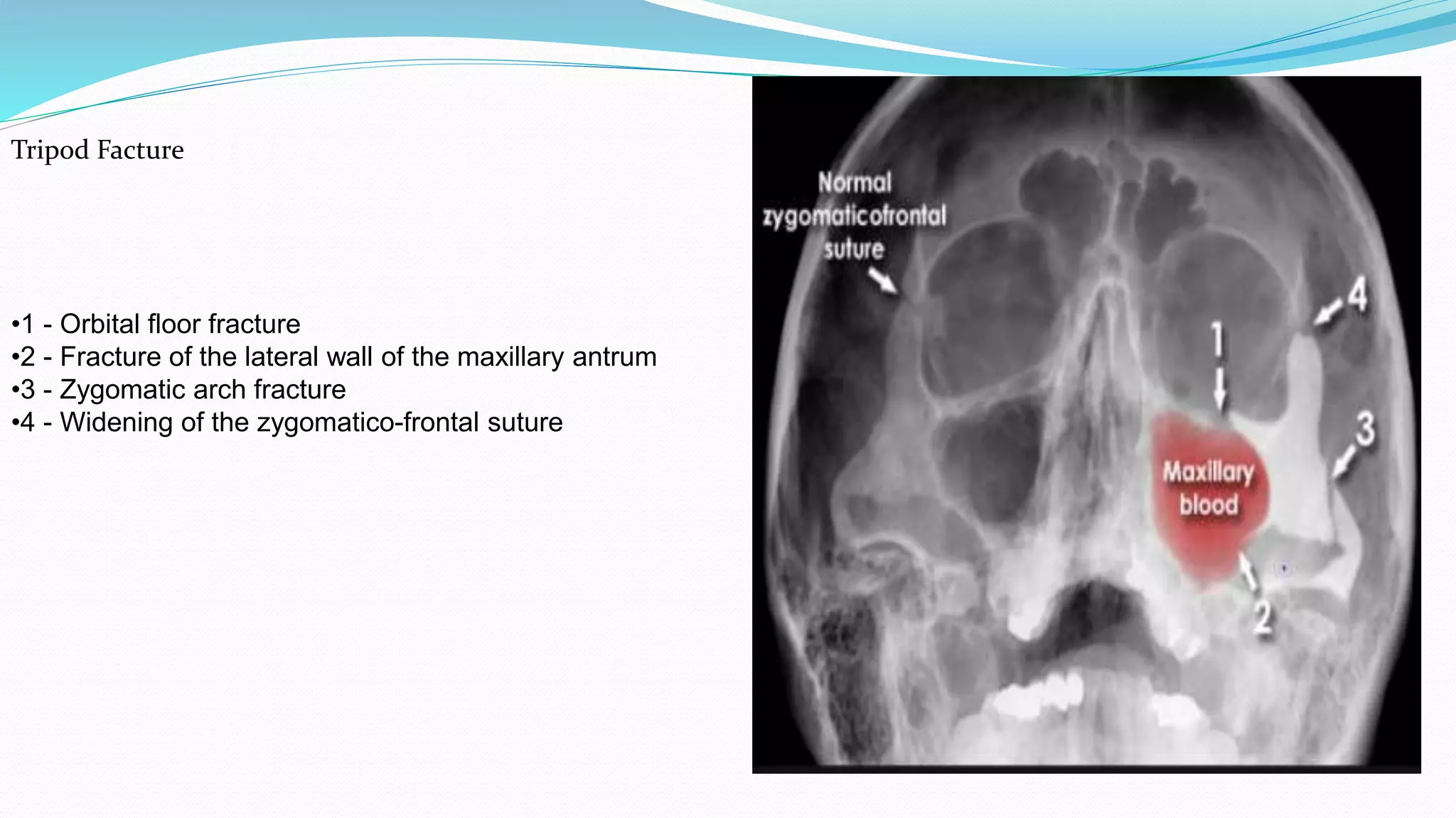 Radiography Anatomy of Skull | PPTX