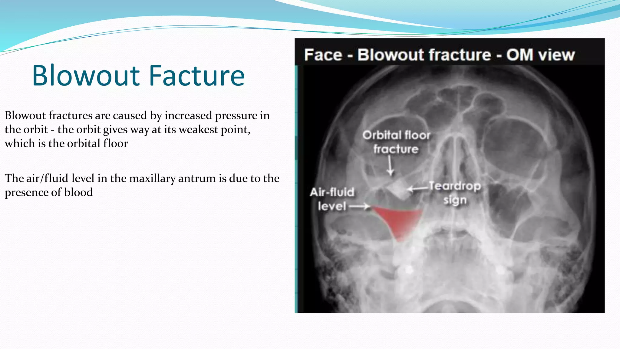 Radiography Anatomy of Skull | PPTX