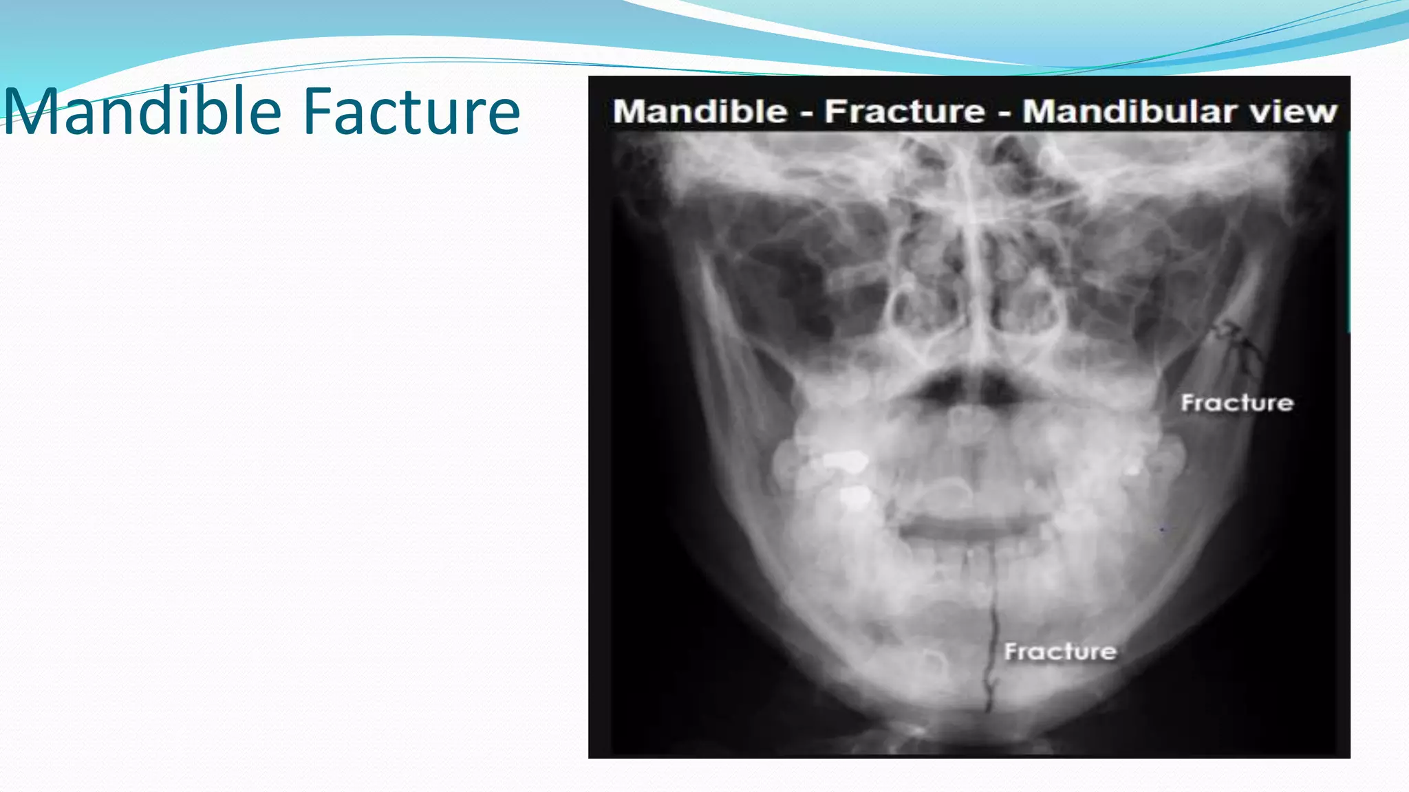 Radiography Anatomy of Skull | PPTX