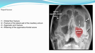 Radiography Anatomy of Skull | PPTX