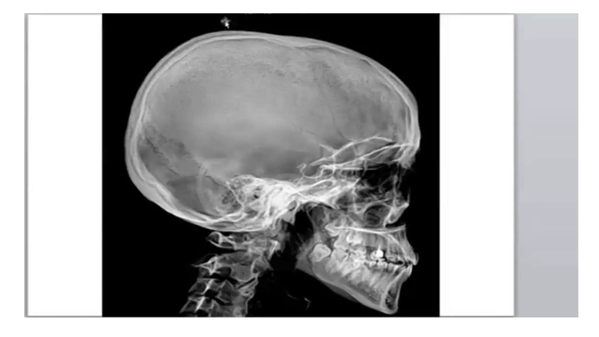Skull X-Ray | PPTX