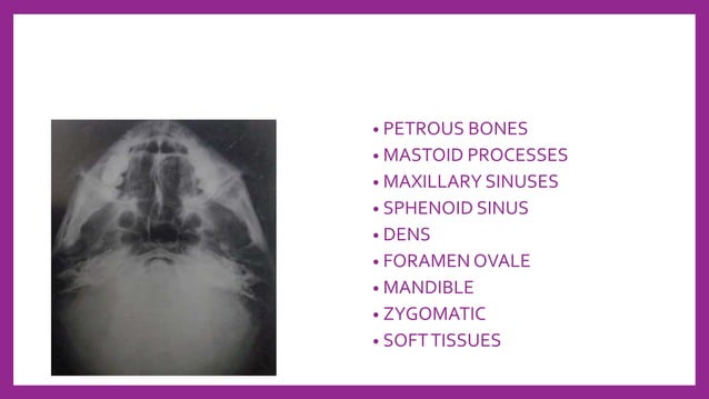 Skull Radiography techniques and reporting | PPTX | Ear, Nose and ...